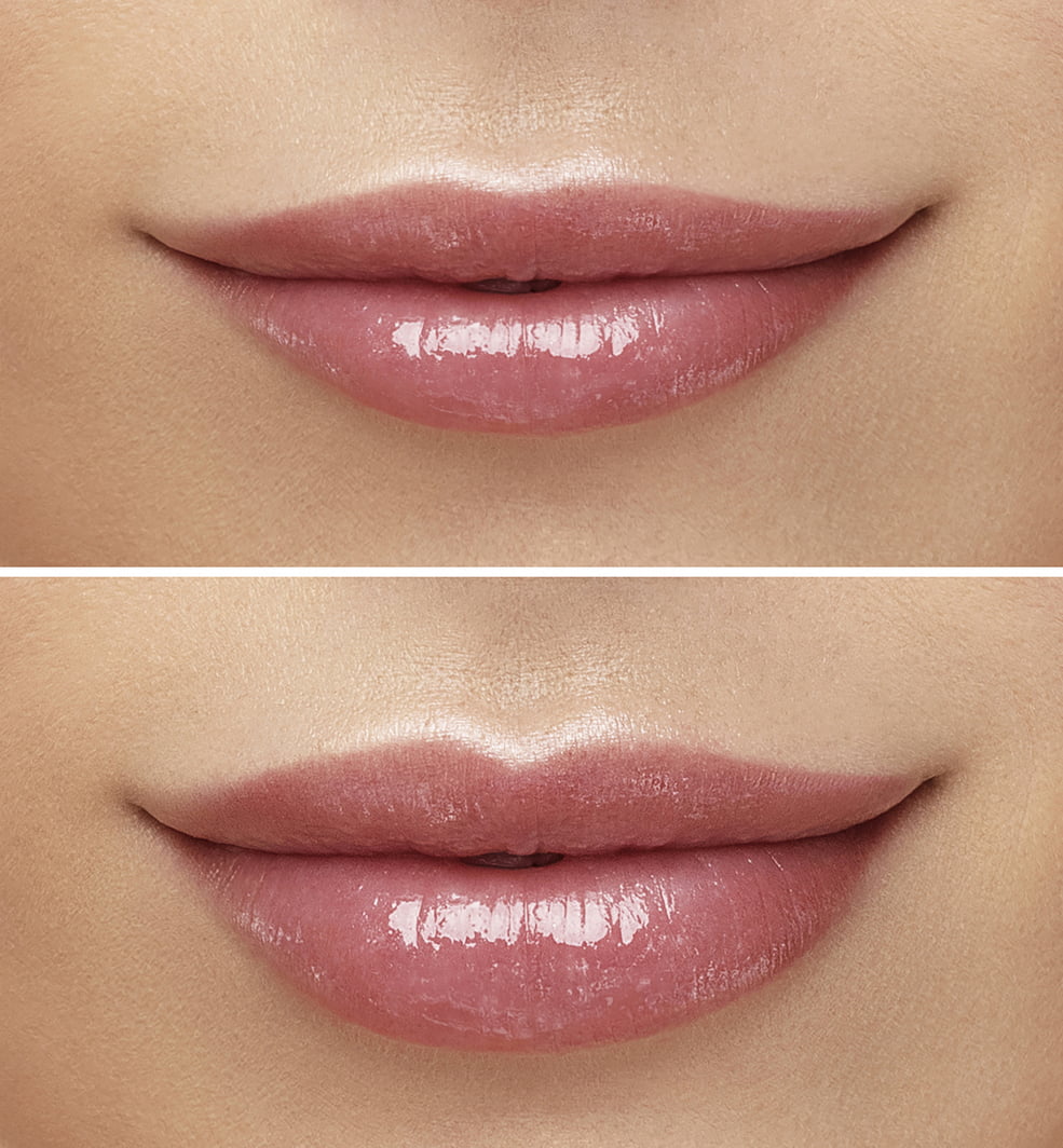 LIp Filler Bournemouth - Lip Enhancement in Poole